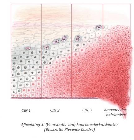 Beeld bij voorstadia van baarmoederhalskanker