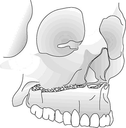 Afbeelding van een schedel en de bovenkaak