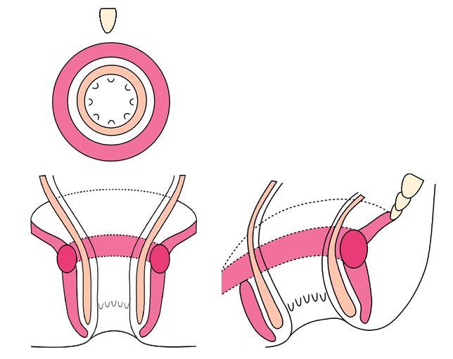 Illustratie van de behandeling van een fistel bij de anus