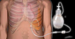 Plaats van de katheter