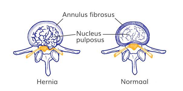afbeelding rughernia