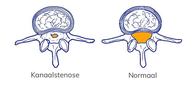 afbeelding kanaalstenose